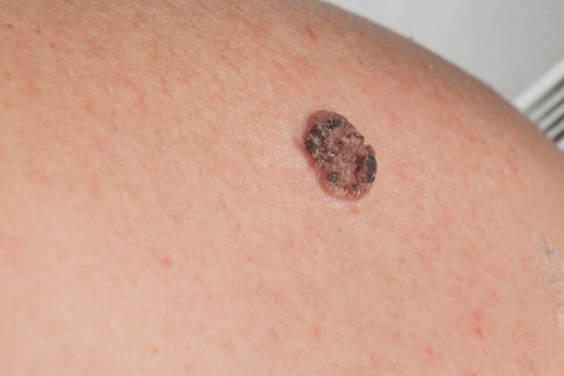 Il trattamento del carcinoma cutaneo a cellule squamose - Dermakos