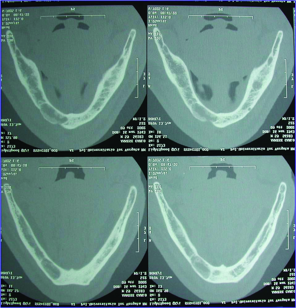 Fig. 15 TC Dentascan prima della chirurgia implantare. - Doctor OS