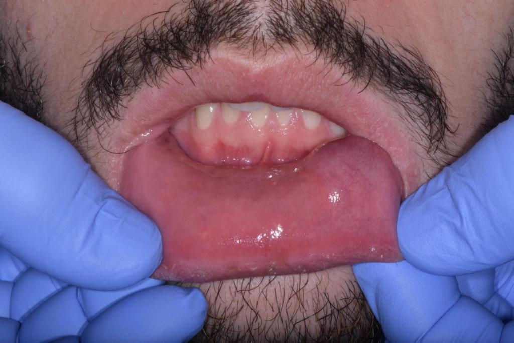 Mucocele orale: inquadramento diagnostico e terapeutico - Doctor OS