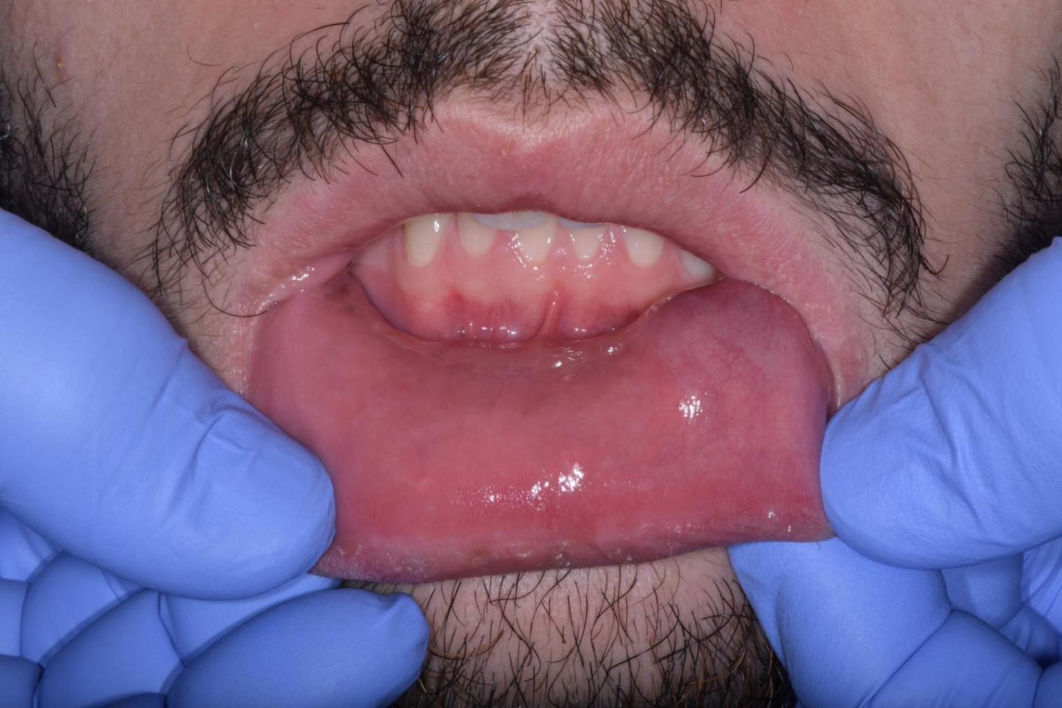 Mucocele orale: inquadramento diagnostico e terapeutico - Doctor OS