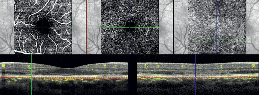 Acute macular neuroretinopathy e paracentral acute middle maculopathy ...
