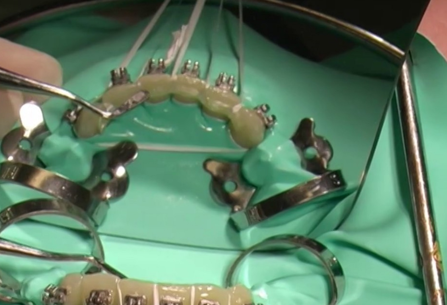 Tre video, dallo splintaggio al preplating passando per l'impianto