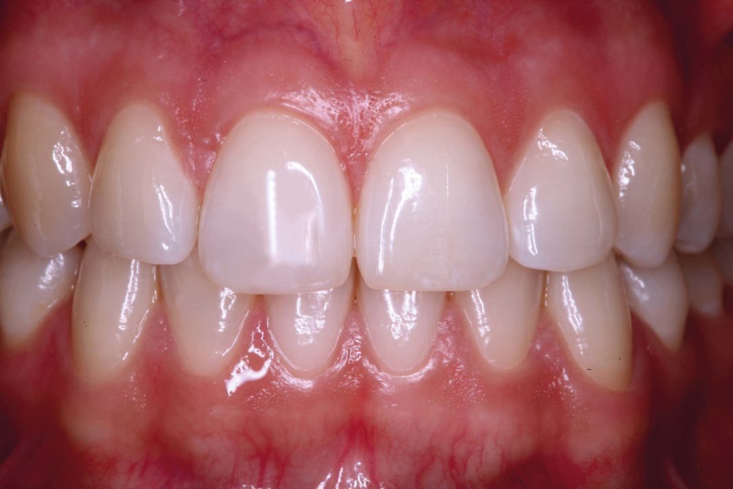 I frenuli labiali: diagnosi e tecniche chirurgiche nel bambino, nell ...