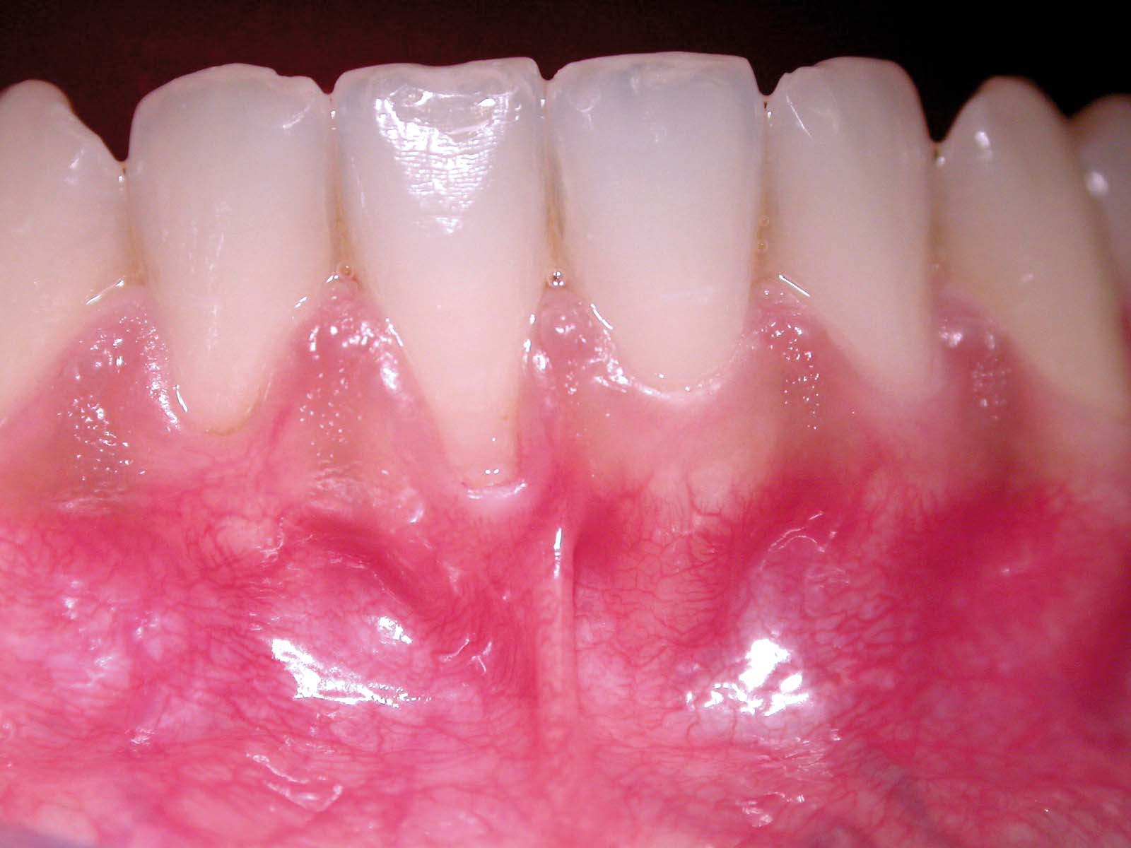 I frenuli labiali: diagnosi e tecniche chirurgiche nel bambino, nell ...