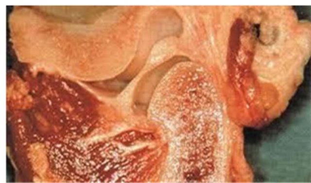 Articolazione temporomandibolare: studio ecografico della morfologia ...