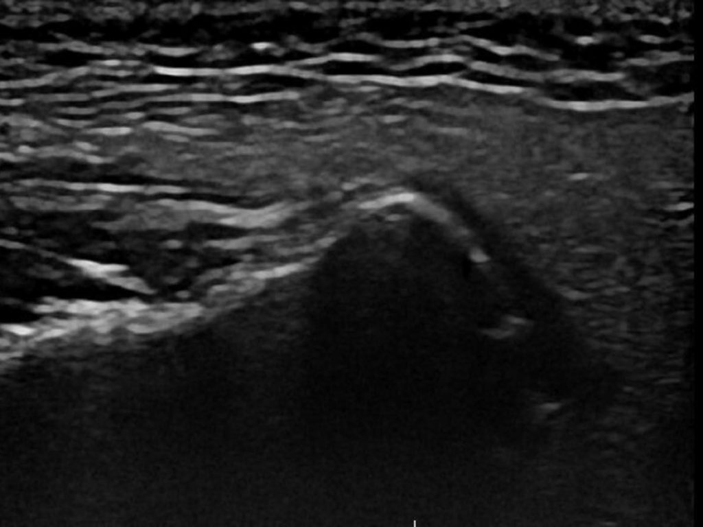 Articolazione temporomandibolare: studio ecografico della morfologia ...