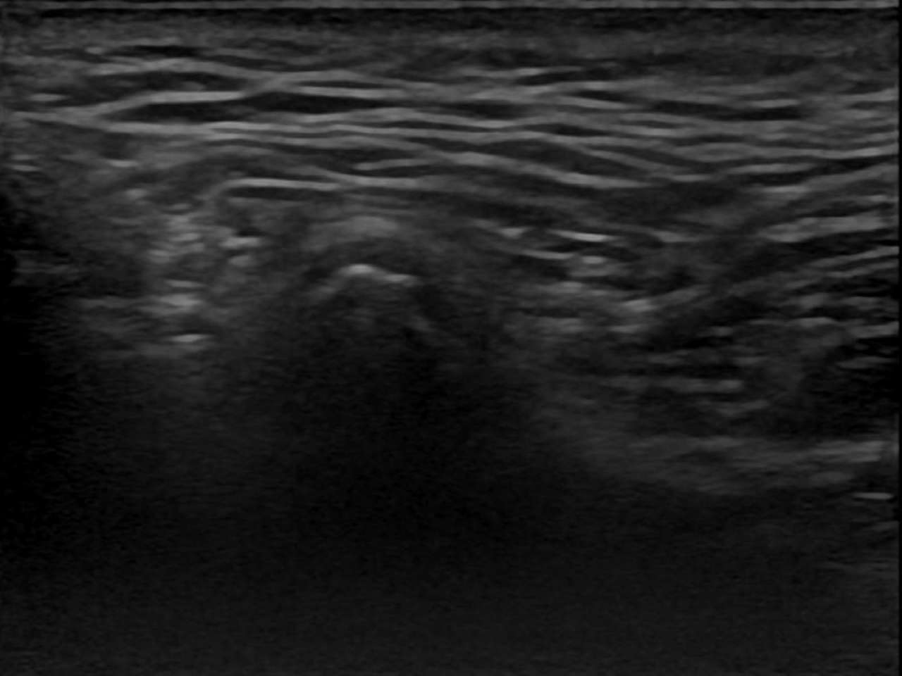 Articolazione temporomandibolare: studio ecografico della morfologia ...