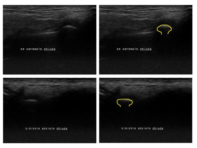 Articolazione temporomandibolare: studio ecografico della morfologia ...