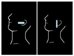 Articolazione temporomandibolare: studio ecografico della morfologia ...