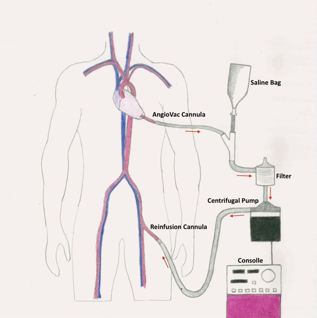 Cardiochirurgia, intervento innovativo a Padova - Tecnica Ospedaliera