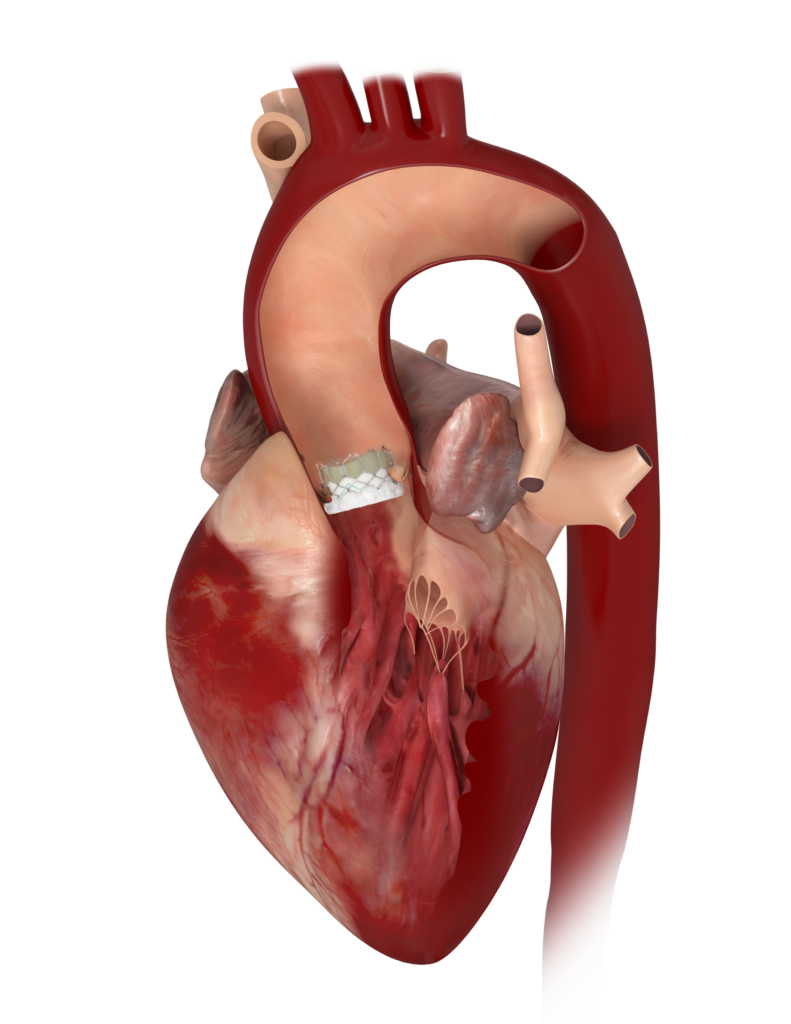 Valvola cardiaca transcatetere per pazienti con stenosi aortica ...